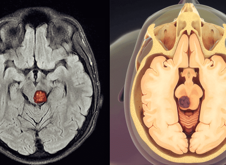 Cerebral Cavernous Malformation | Birth Injury Center